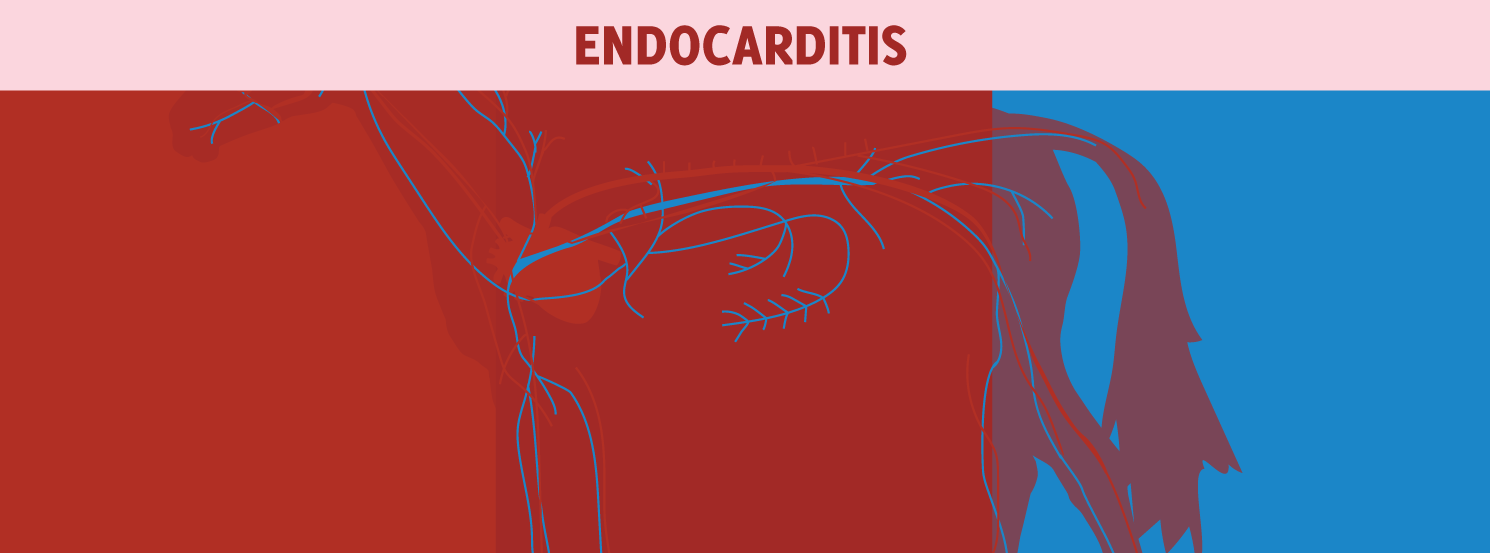 Endocarditis | HorseDVM Diseases A-Z